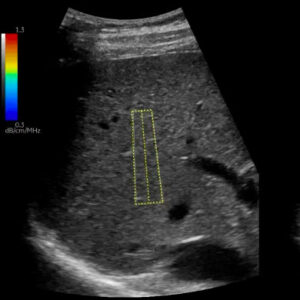 Liver Elastography – NIA Diagnostic Imaging